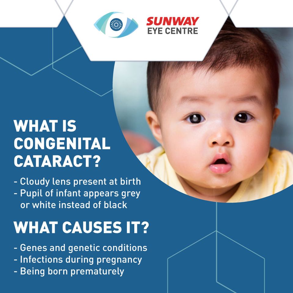Cataracts In Eyes